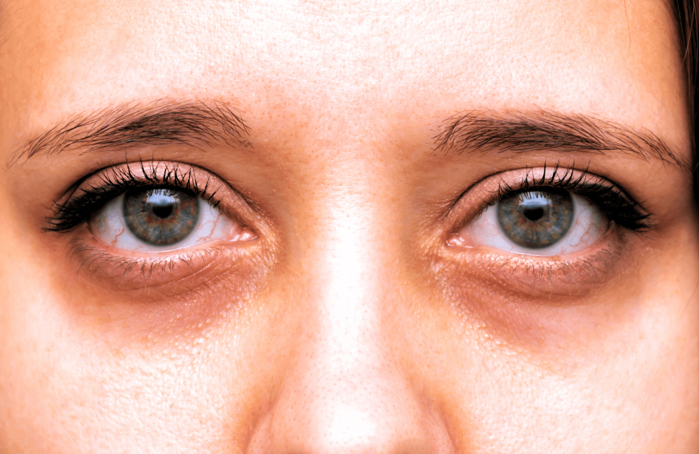 Why Allergies Might Be Causing Your Dark Under-Eye Circles – Soul Space
